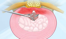 Cadaveric Hands-on Instruction with Disc-FX